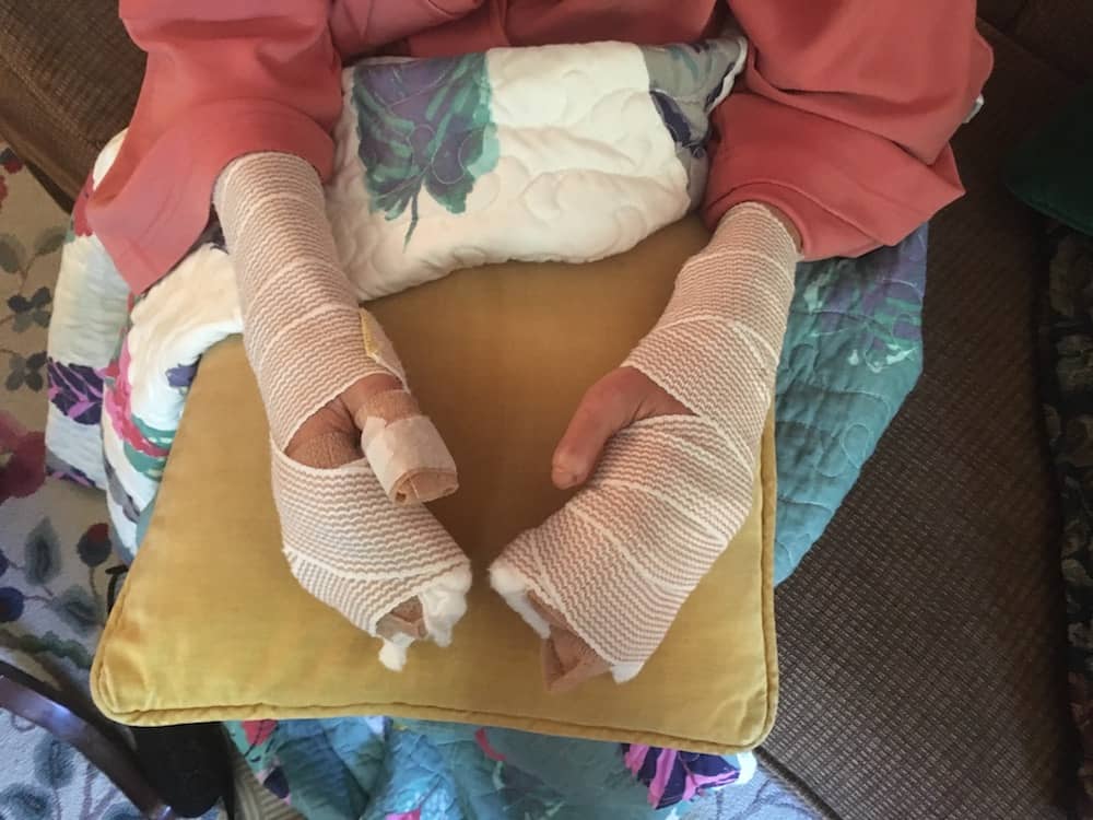 So Far, So Good - Living with Scleroderma